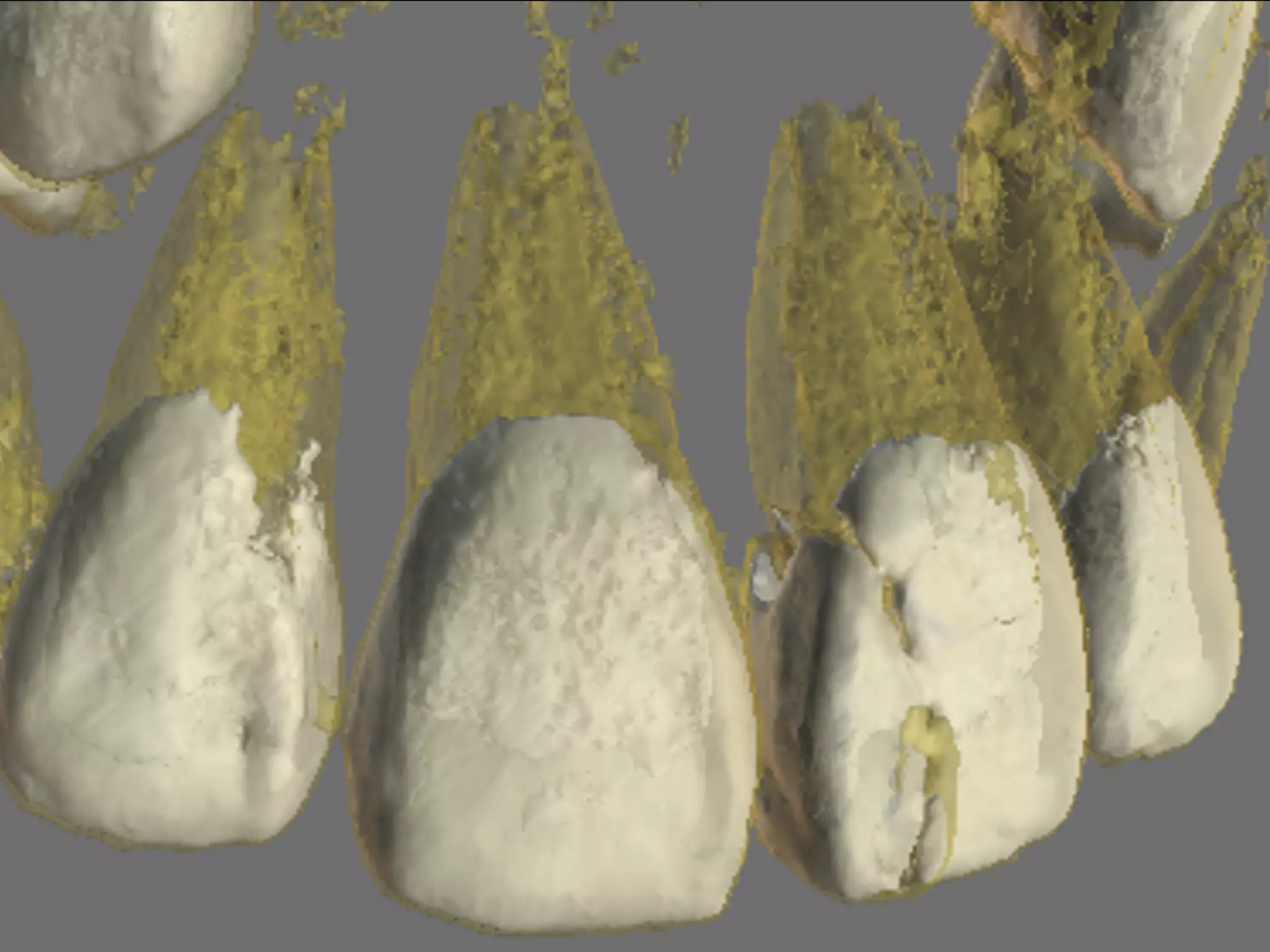 Tooth fragment reattachment and vital pulp therapy | PDF