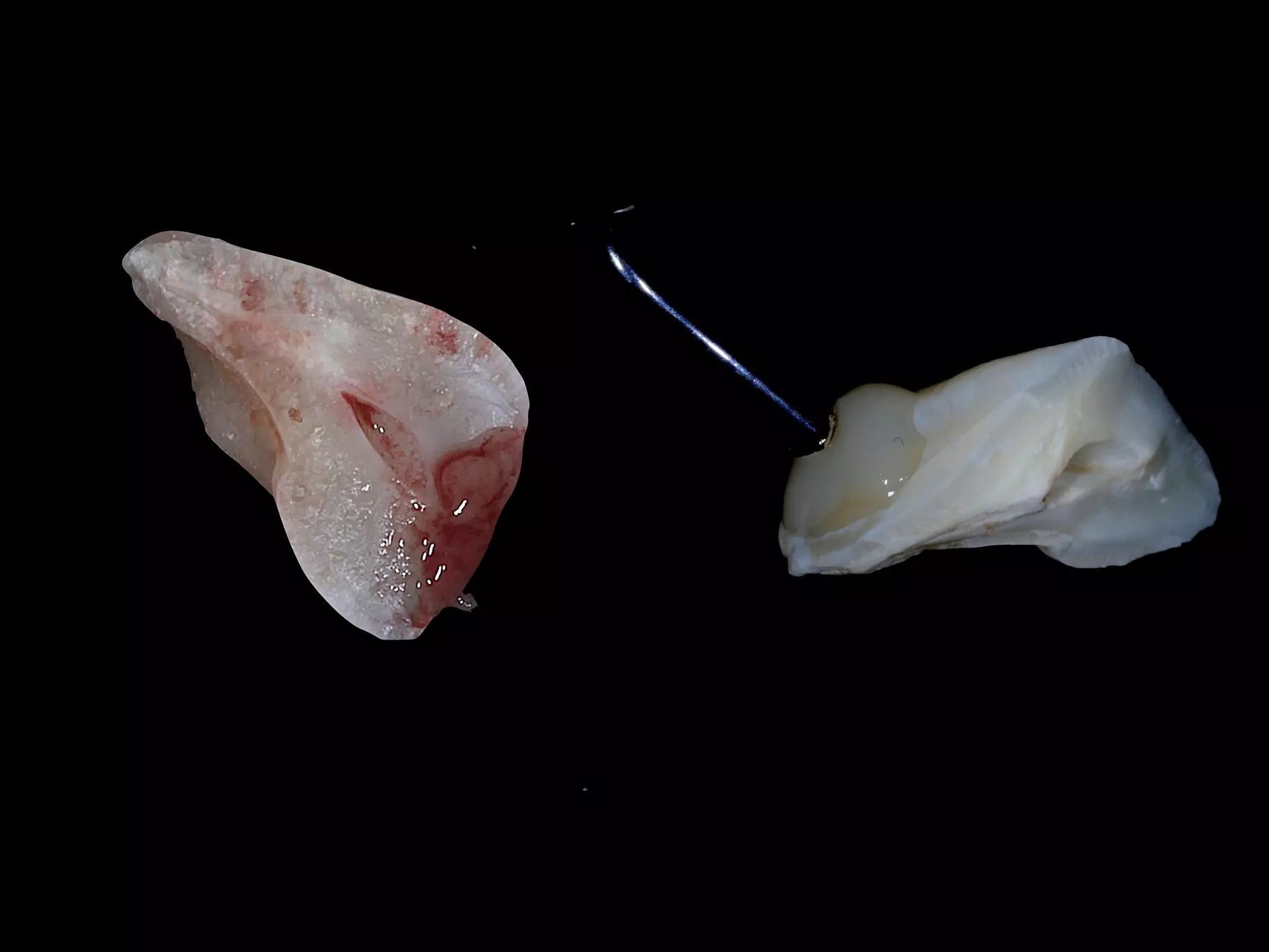 Tooth fragment reattachment and vital pulp therapy | PDF