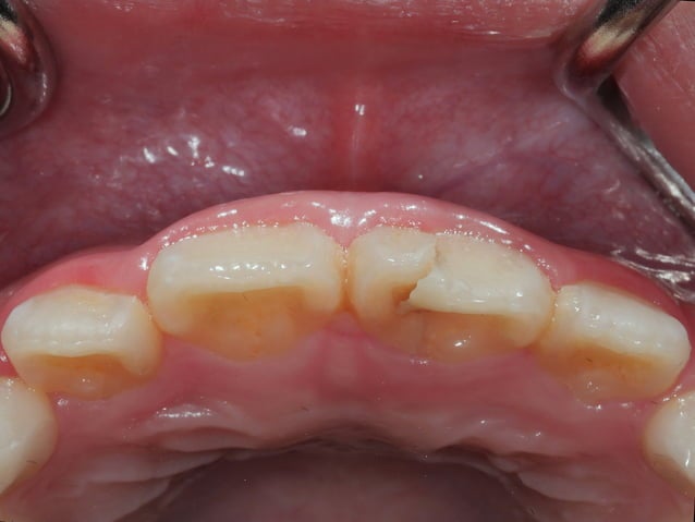 Tooth fragment reattachment and vital pulp therapy | PDF