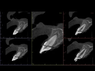Tooth fragment reattachment and vital pulp therapy | PDF