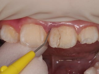 Tooth fragment reattachment and vital pulp therapy | PDF