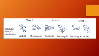 Tooth impaction | PPTX