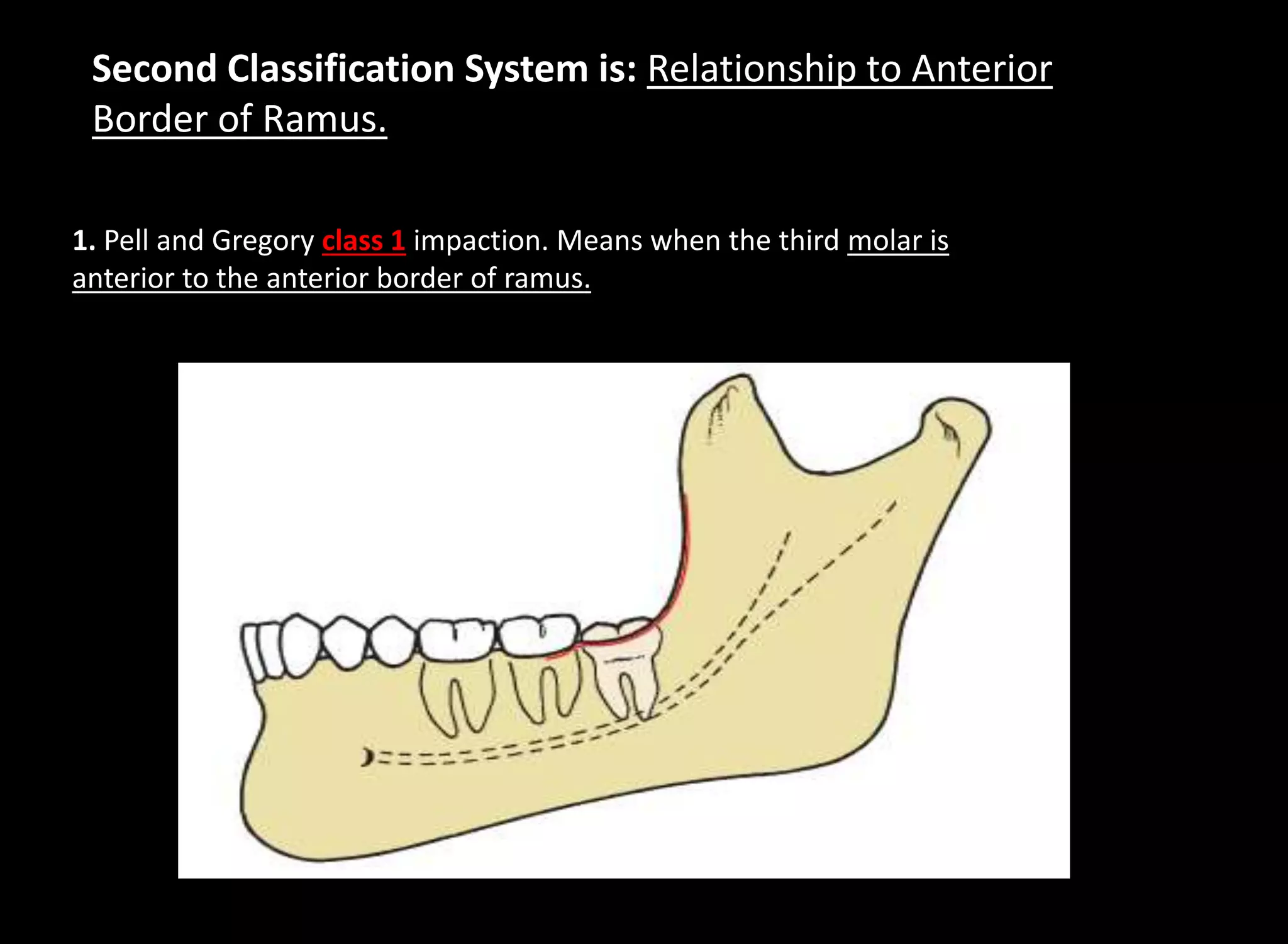 Tooth impaction | PPTX