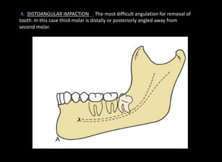Tooth impaction | PPTX