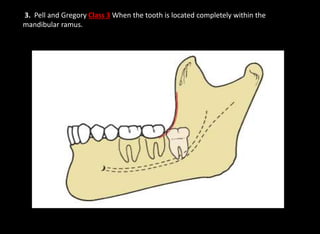 Tooth impaction | PPTX