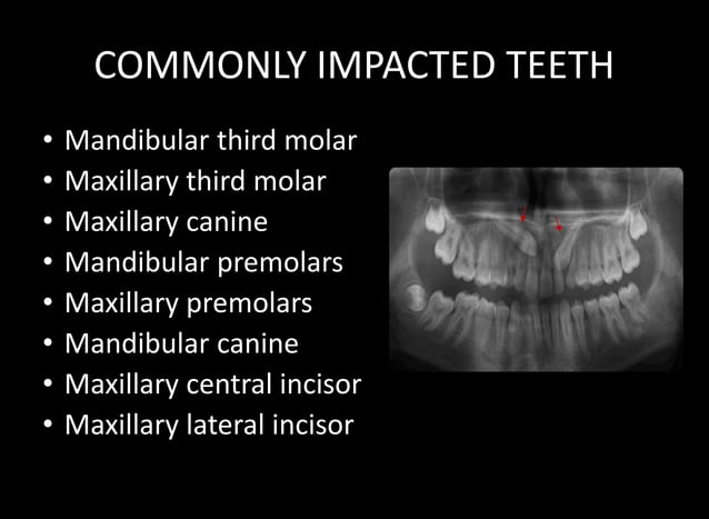 Tooth impaction | PPTX