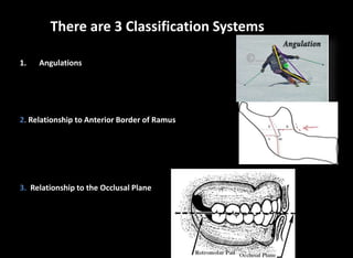 Tooth impaction | PPTX