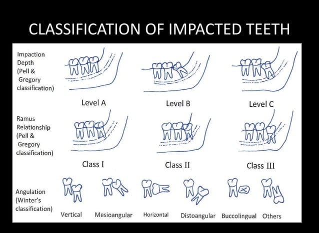 Tooth impaction | PPTX