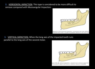Tooth impaction | PPTX