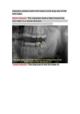 Tooth impaction seminar | DOCX