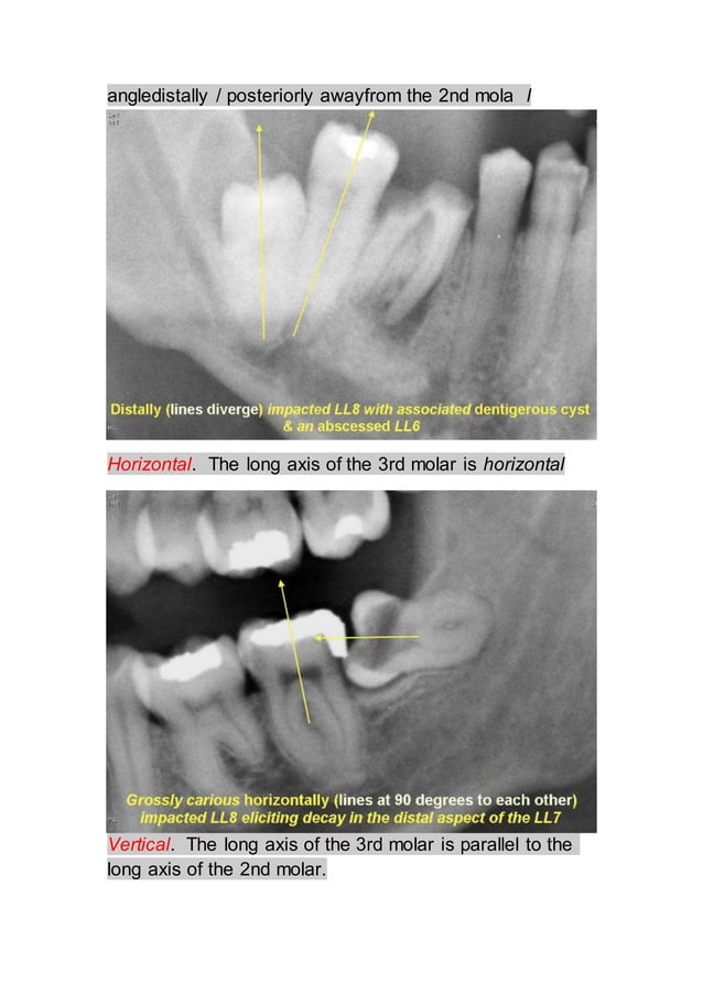 Tooth impaction seminar | PDF