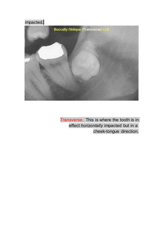 Tooth impaction seminar | DOCX | Dental Health | Diseases and Conditions