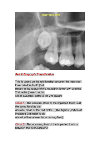 Tooth impaction seminar | DOCX | Dental Health | Diseases and Conditions