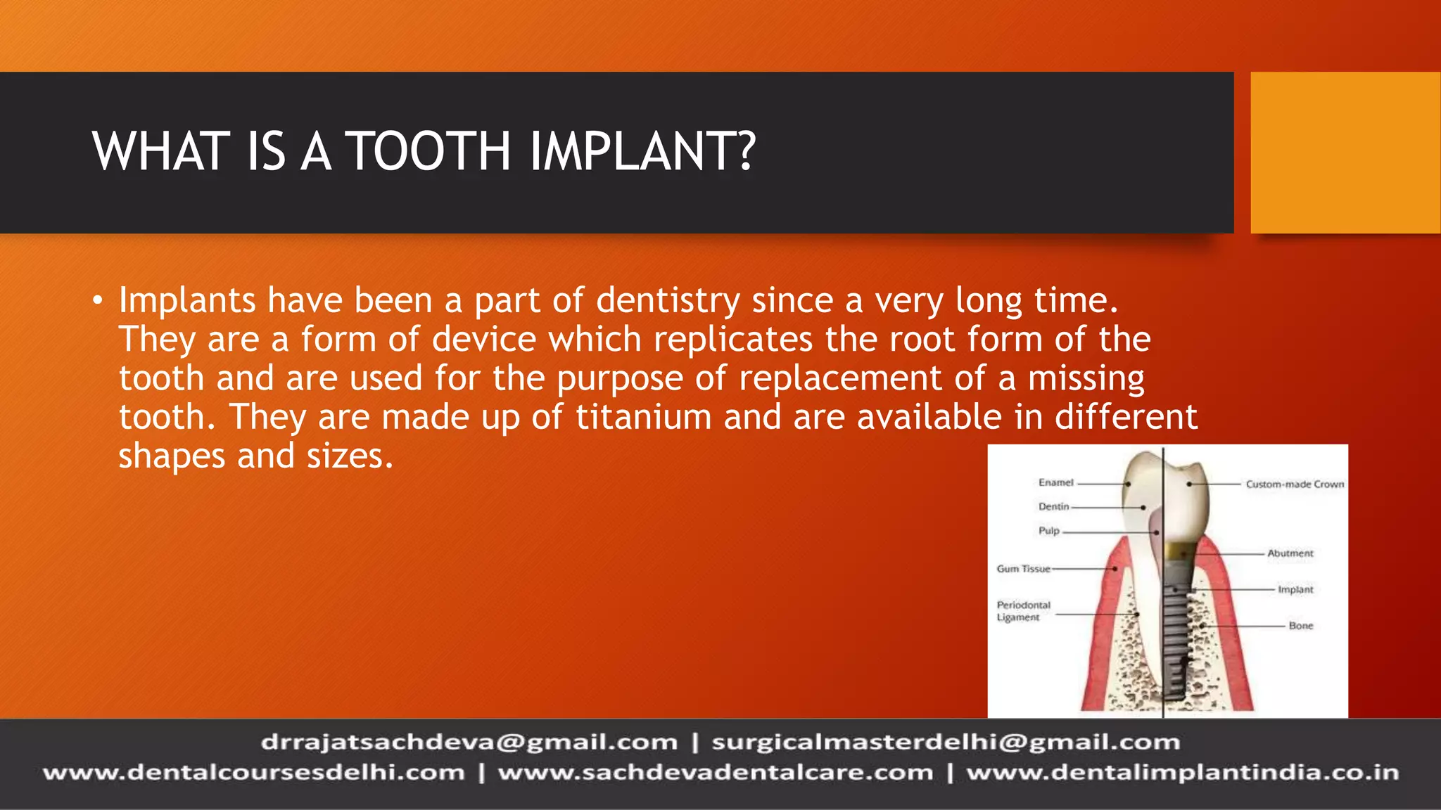 Tooth Implant in Delhi | Dental Implants treatment in delhi | Tooth ...