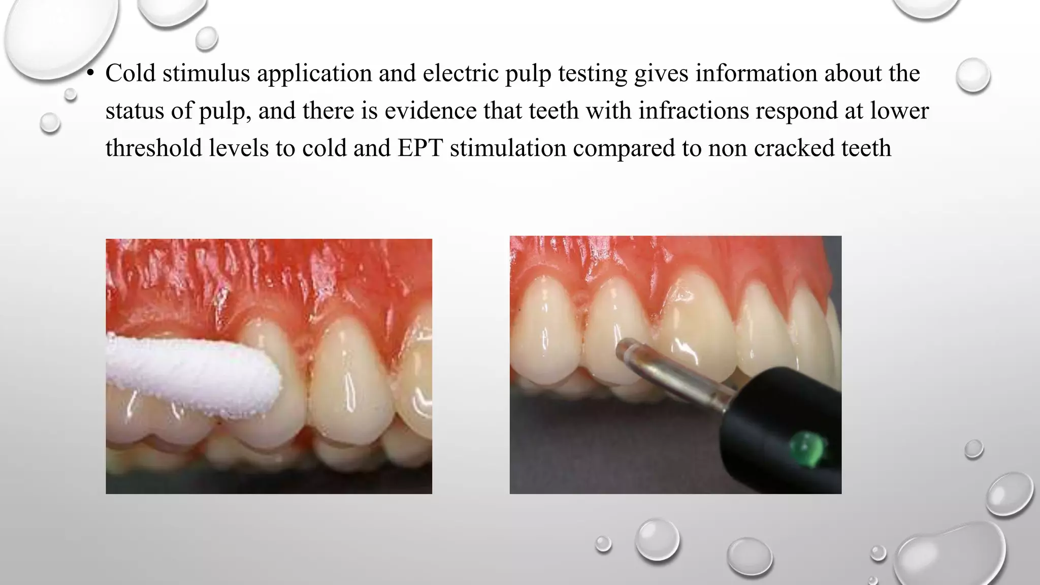 Tooth infarction | PPTX