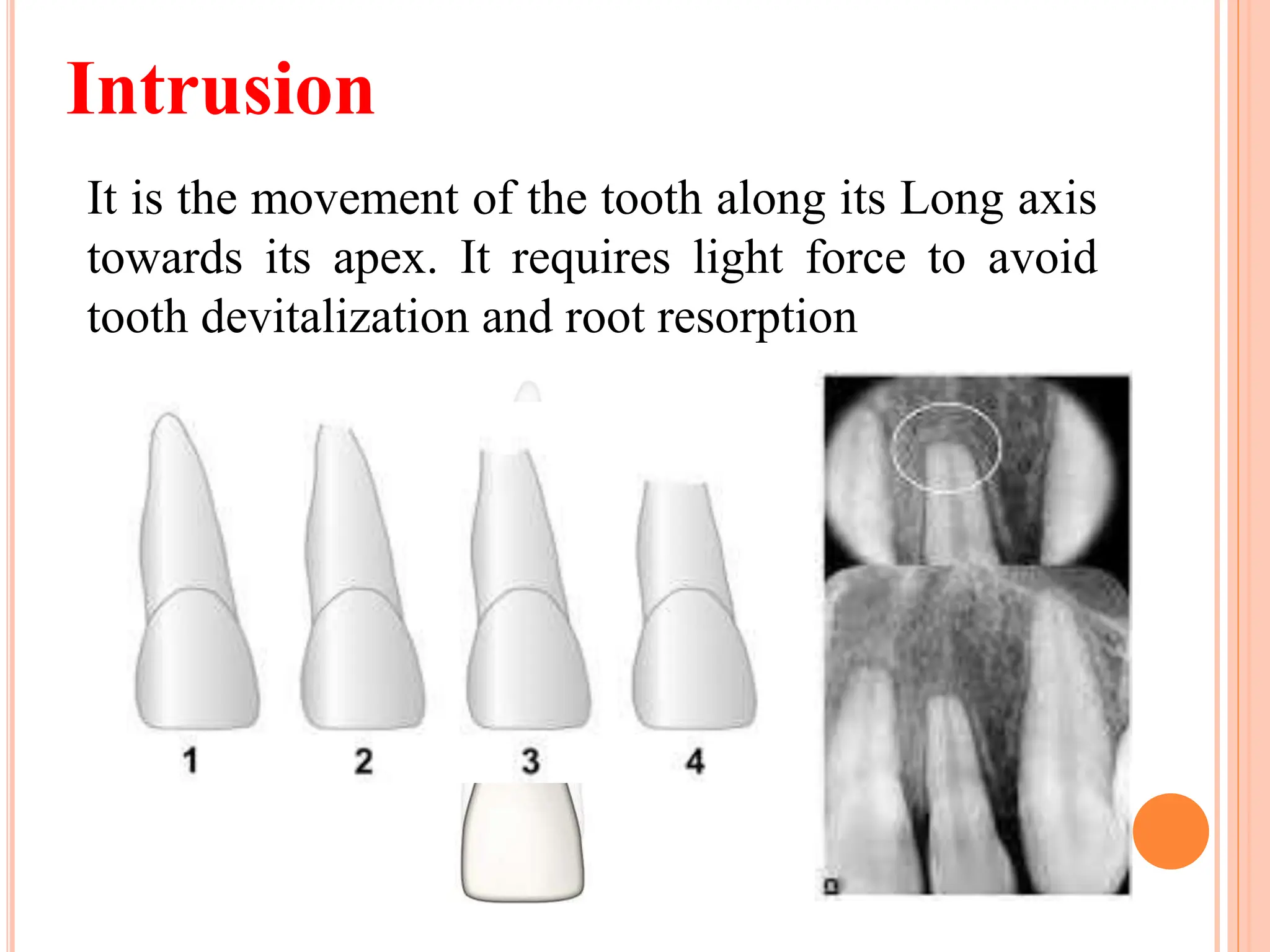 Tooth movement in orthodontics how and why | PPTX | Dental Health ...