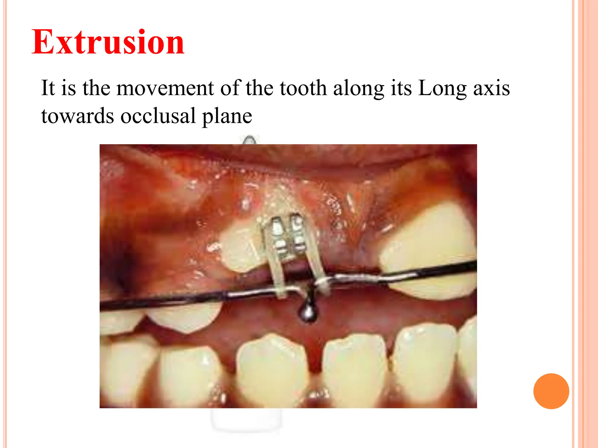 Tooth movement in orthodontics how and why | PPTX | Dental Health ...
