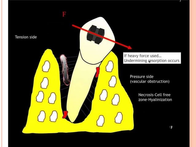 Tooth movement in orthodontics how and why | PPTX | Dental Health ...