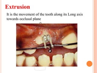 Tooth movement in orthodontics how and why | PPTX | Dental Health ...