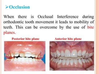 Tooth movement in orthodontics how and why | PPTX | Dental Health ...