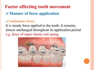 Tooth movement in orthodontics how and why | PPTX | Dental Health ...