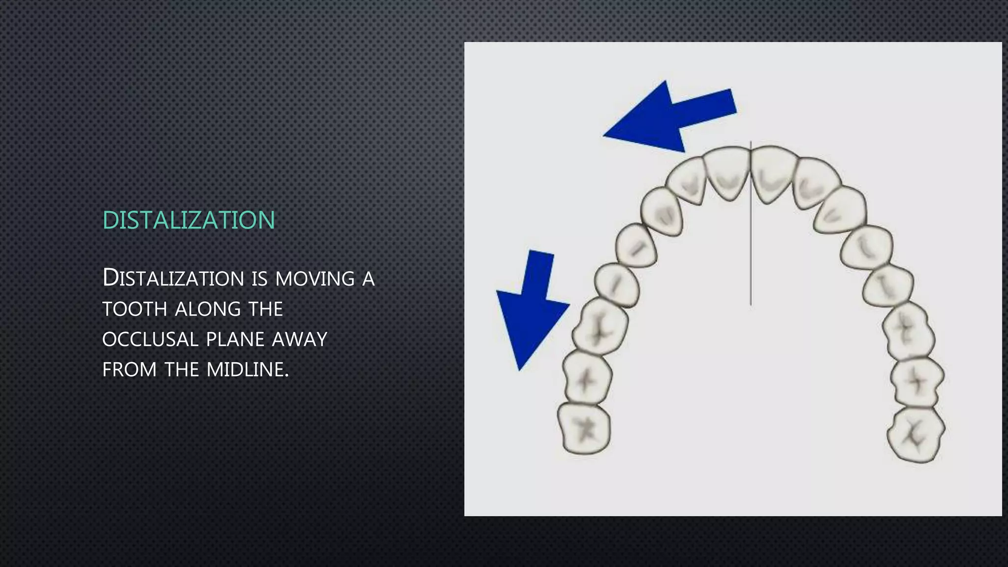 Orthodontic Tooth movement types | PPTX