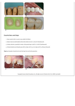 Zirconia Crowns Preparation