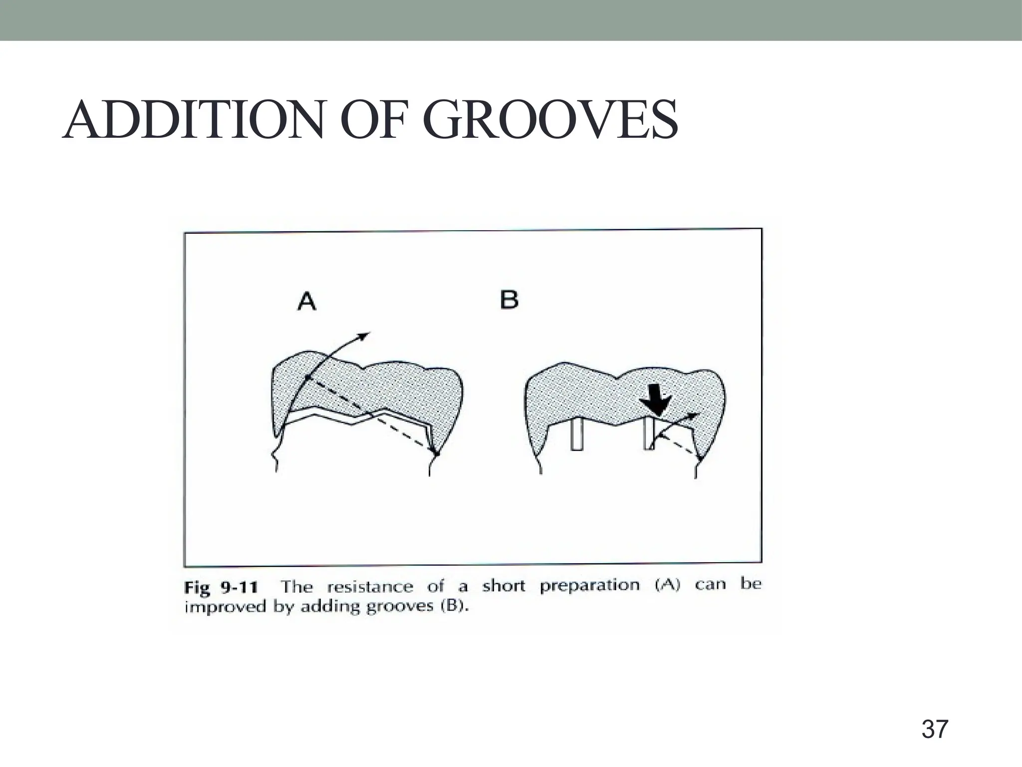 tooth preparation and it's modifications | PPT