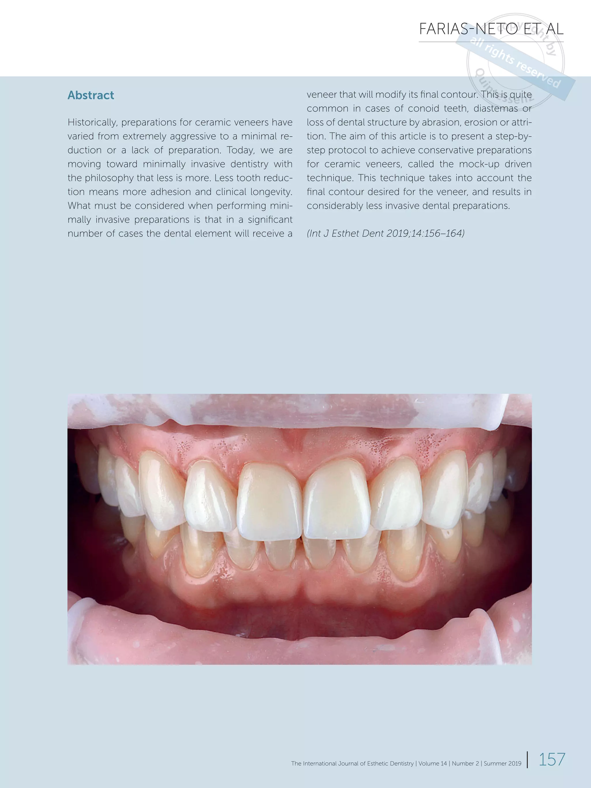 Tooth_preparation_for ceramic_veneers_when_less_is_more.pdf