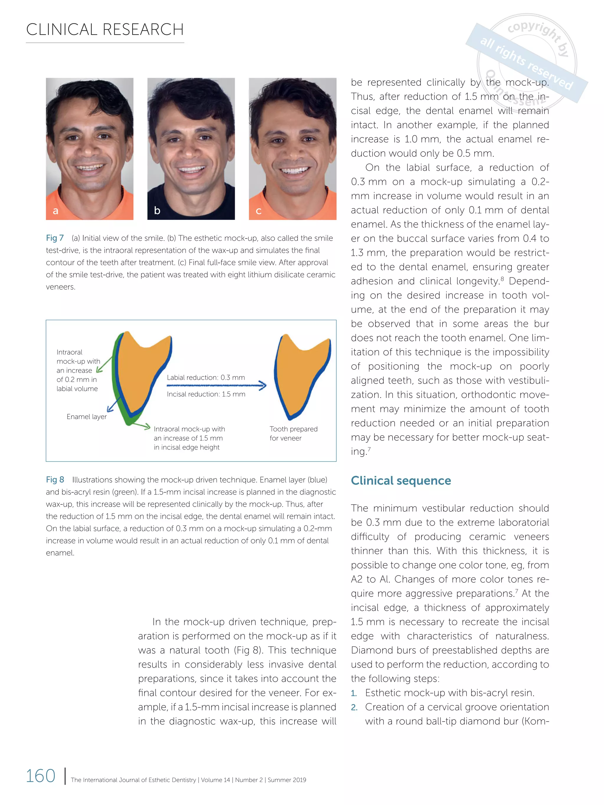 Tooth_preparation_for ceramic_veneers_when_less_is_more.pdf