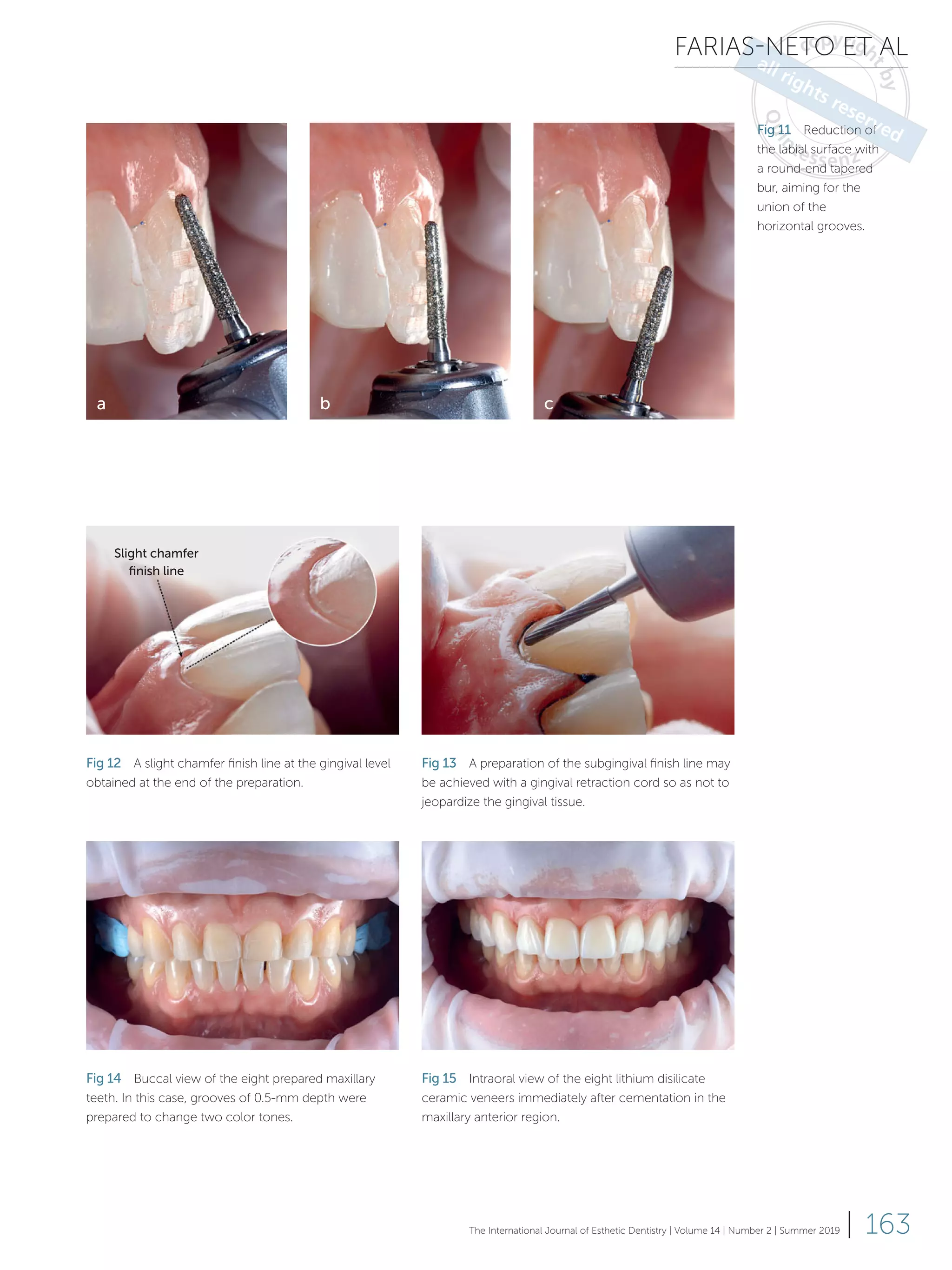 Tooth_preparation_for ceramic_veneers_when_less_is_more.pdf