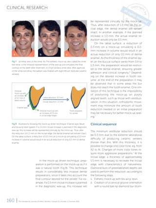 Tooth_preparation_for ceramic_veneers_when_less_is_more.pdf