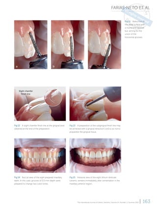 Tooth_preparation_for ceramic_veneers_when_less_is_more.pdf