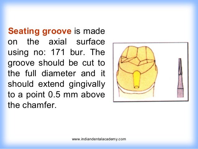 Tooth preparation for full veneer crowns /certified fixed orthodonti…