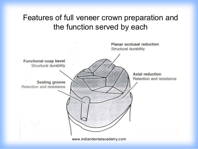 Tooth preparation for full veneer crowns /certified fixed orthodonti…