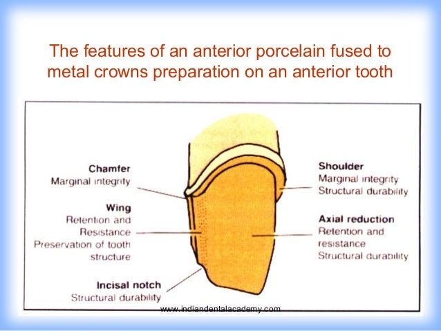 Porcelain Veneer Preparation Guidelines - Design Talk