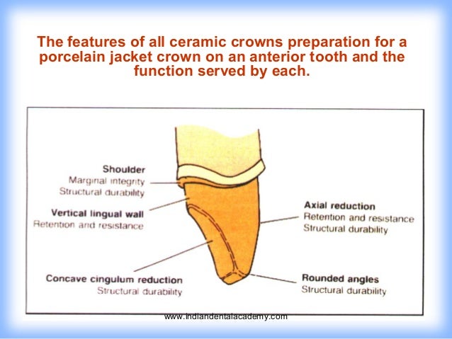 Tooth preparation for full veneer crowns /certified fixed orthodonti…