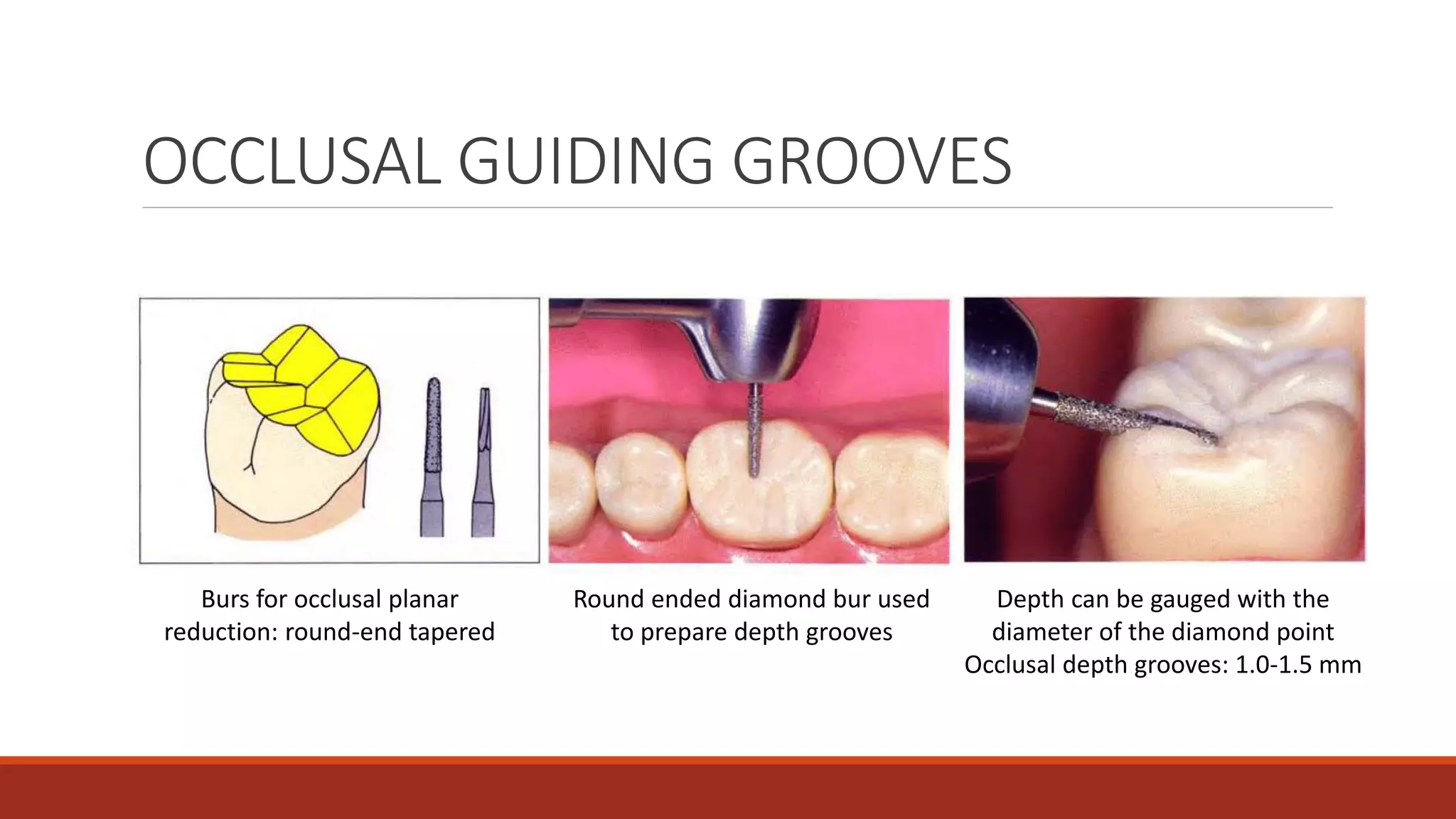 TOOTH PREPARATION: FULL VENEER CAST METAL CROWN | PPTX