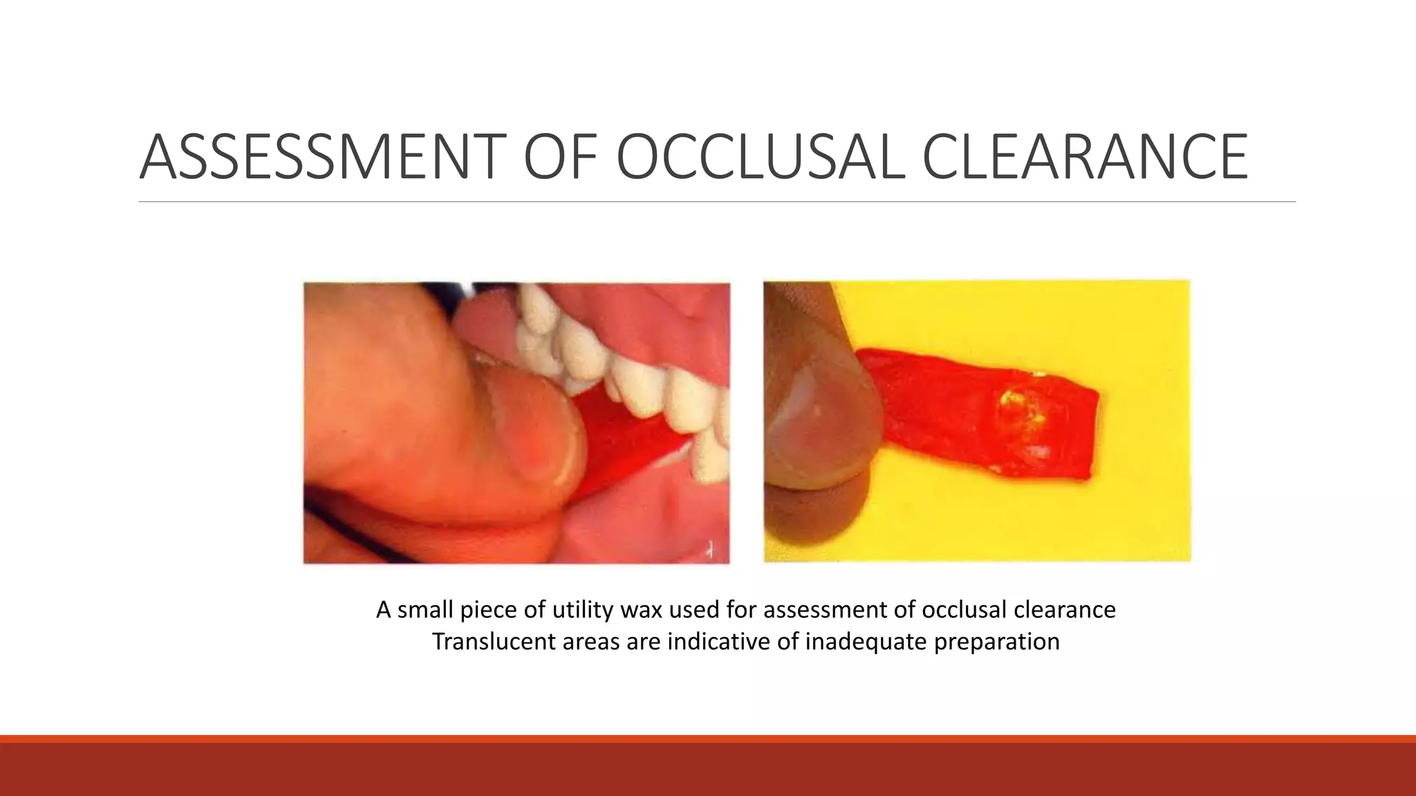 TOOTH PREPARATION: FULL VENEER CAST METAL CROWN | PPTX
