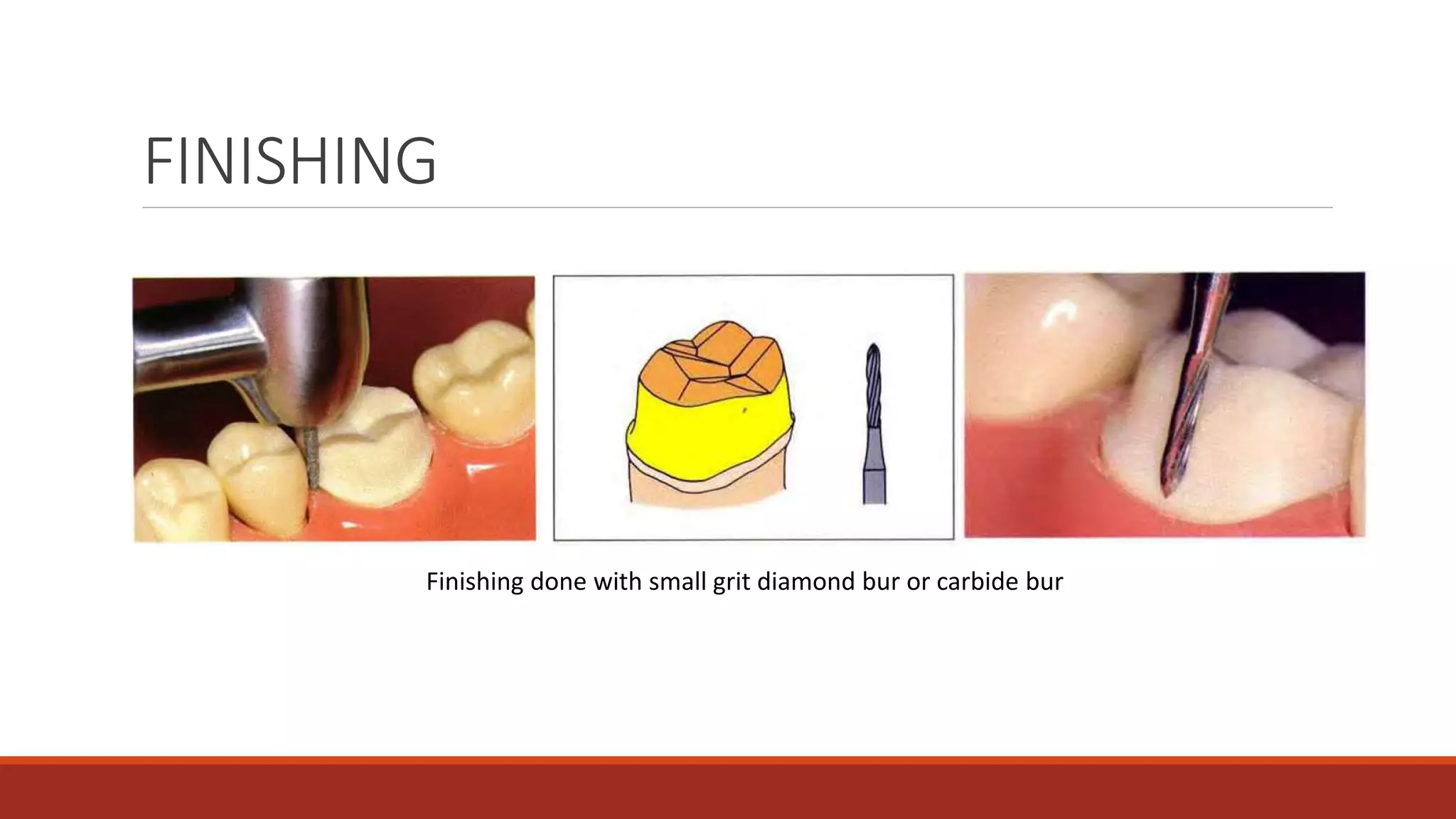 TOOTH PREPARATION: FULL VENEER CAST METAL CROWN | PPTX