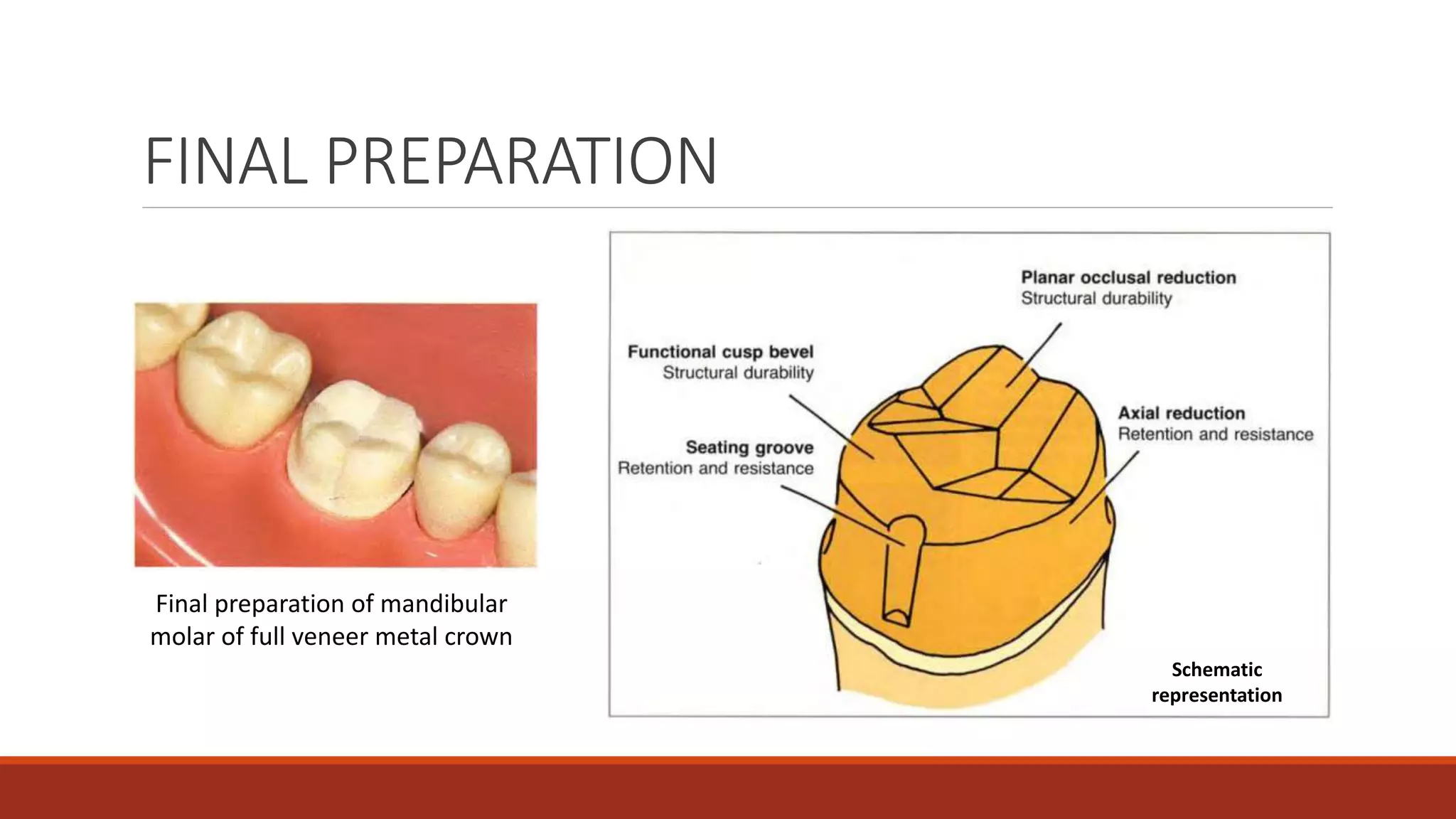 TOOTH PREPARATION: FULL VENEER CAST METAL CROWN | PPTX
