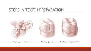 TOOTH PREPARATION: FULL VENEER CAST METAL CROWN | PPTX