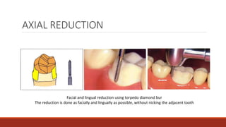 TOOTH PREPARATION: FULL VENEER CAST METAL CROWN | PPTX