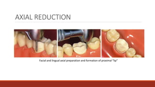 TOOTH PREPARATION: FULL VENEER CAST METAL CROWN | PPTX