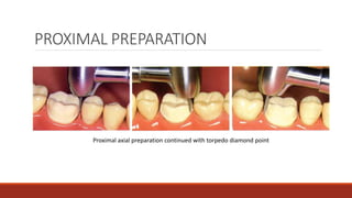 TOOTH PREPARATION: FULL VENEER CAST METAL CROWN | PPTX