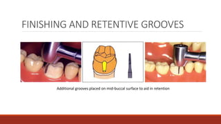 TOOTH PREPARATION: FULL VENEER CAST METAL CROWN | PPTX