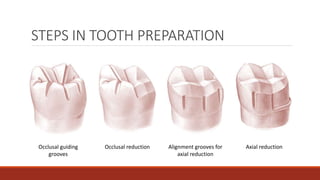 Full Metal Crown Preparation