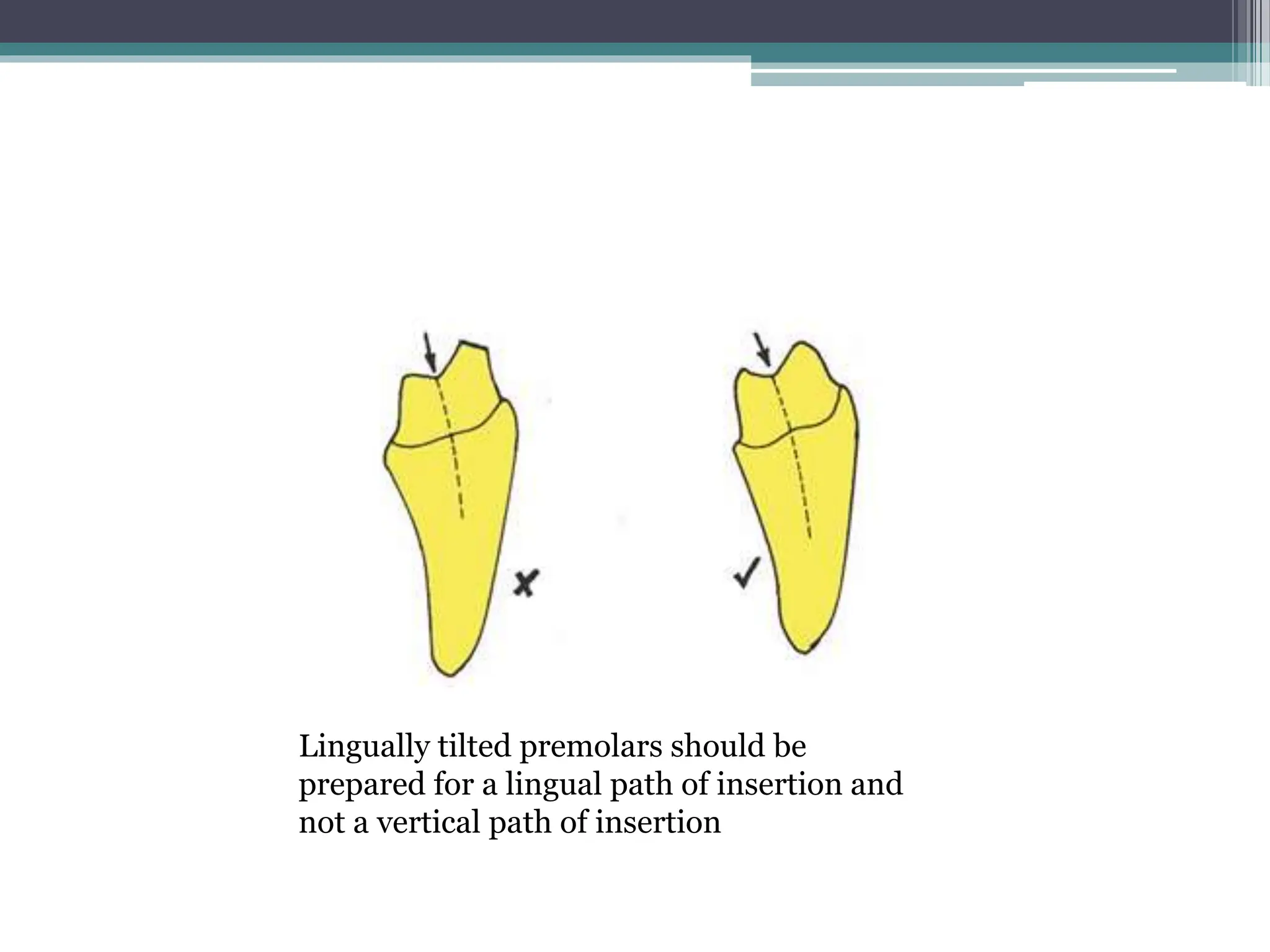 Tooth Preparation in FIXED PARTIAL DENTURE | PPTX