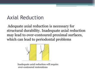 Tooth Preparation in FIXED PARTIAL DENTURE | PPTX