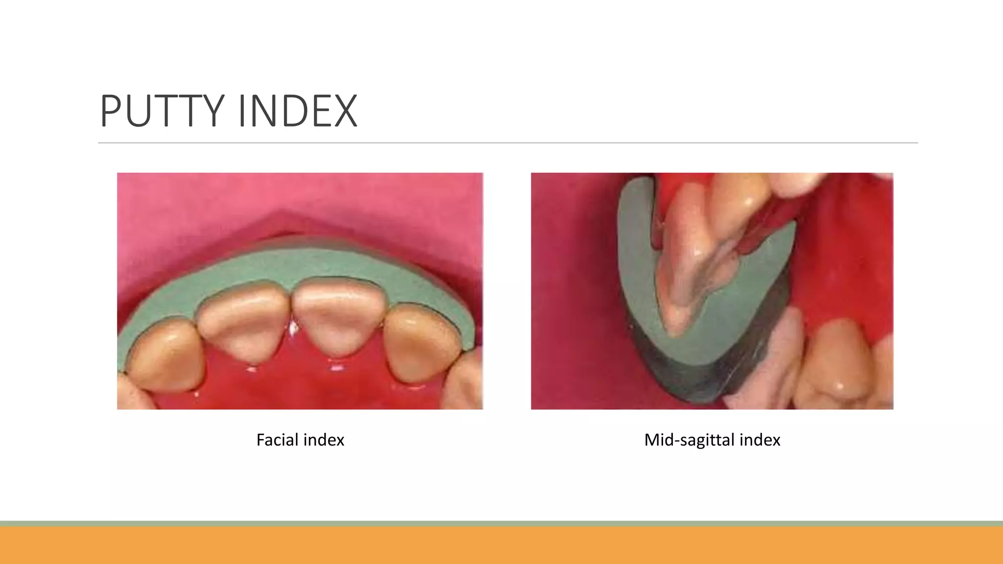 TOOTH PREPARATION: FULL VENEER ANTERIOR PFM | PPTX